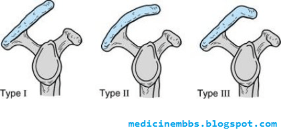 Shoulder Bursitis and Impingement | 321GOMD