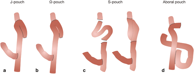 Methods of Reconstruction—BI, BII, Roux-en-Y, Jejunal Interposition, Proximal Gastrectomy and ...