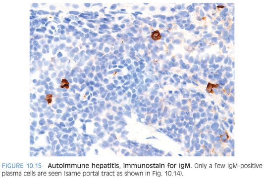 Autoimmune Hepatitis | Abdominal Key