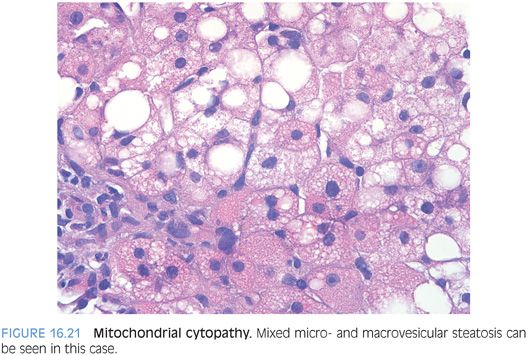 Wilson Disease and Other Genetic Diseases | Abdominal Key