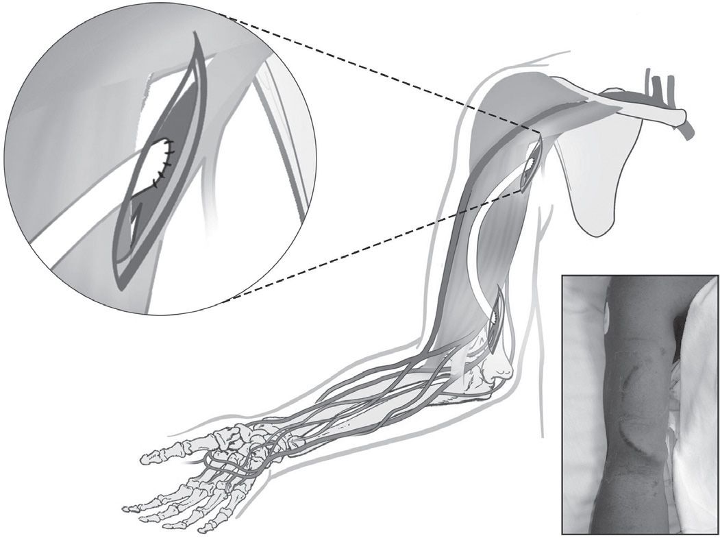 Arteriovenous Fistulas and Grafts: The Basics | Abdominal Key