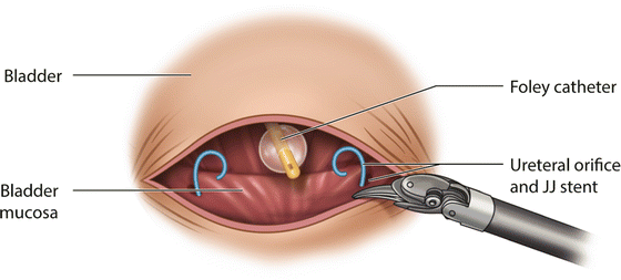 Robotic Rectovesical Fistula Repair | Abdominal Key
