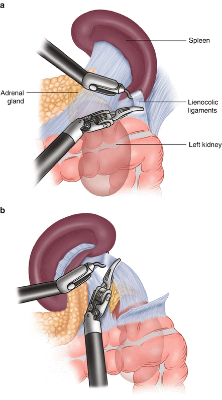 Robot-Assisted Total and Partial Adrenalectomy | Abdominal Key