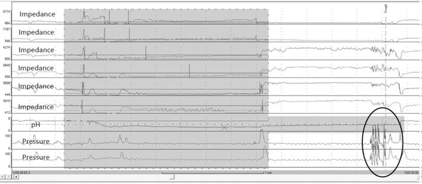 Esophageal pH and Impedance Monitoring | Abdominal Key