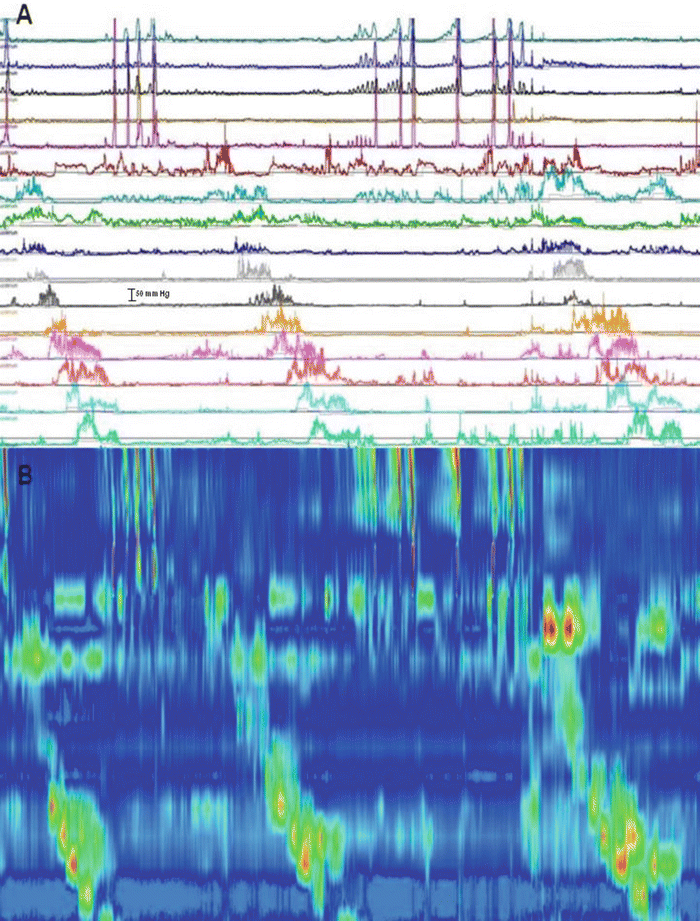 Antroduodenal Manometry | Abdominal Key