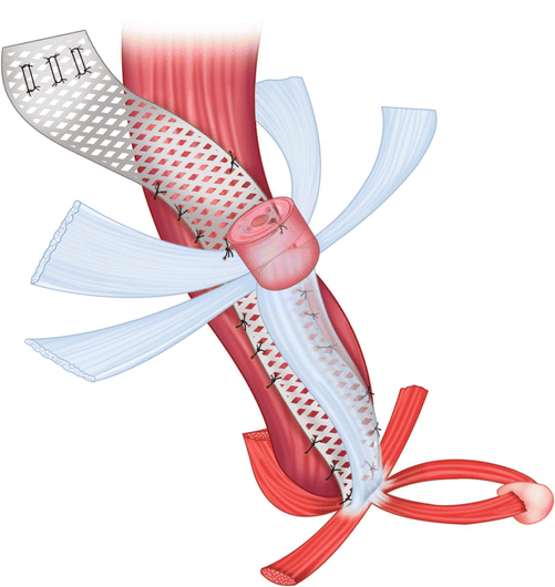 Rectal Prolapse, Intussusception, Solitary Rectal Ulcer | Abdominal Key