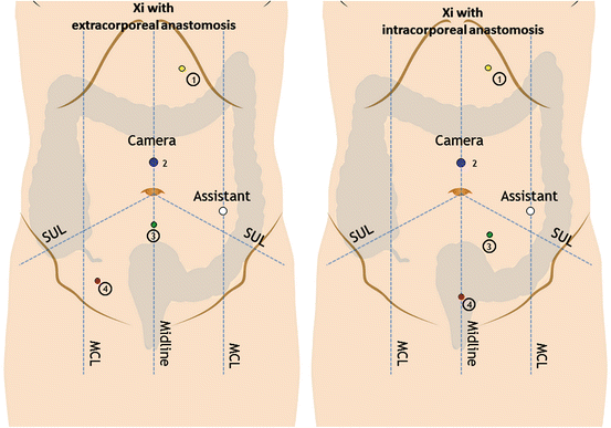Masters Program Colon Pathway: Robotic Right Hemicolectomy | Abdominal Key