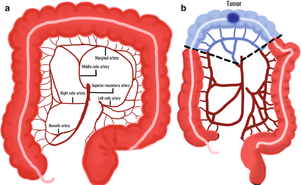 Challenge Of The Transverse Colon Tumor Laparoscopic Techniques And Challenge Of The Transverse Colon Tumor Laparoscopic Techniques And