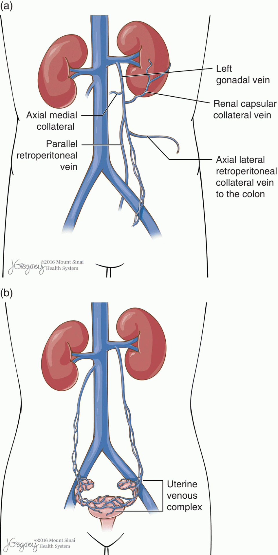 Gonadal Vein Embolization Abdominal Key gonadal-vein-embolization-abdominal-key