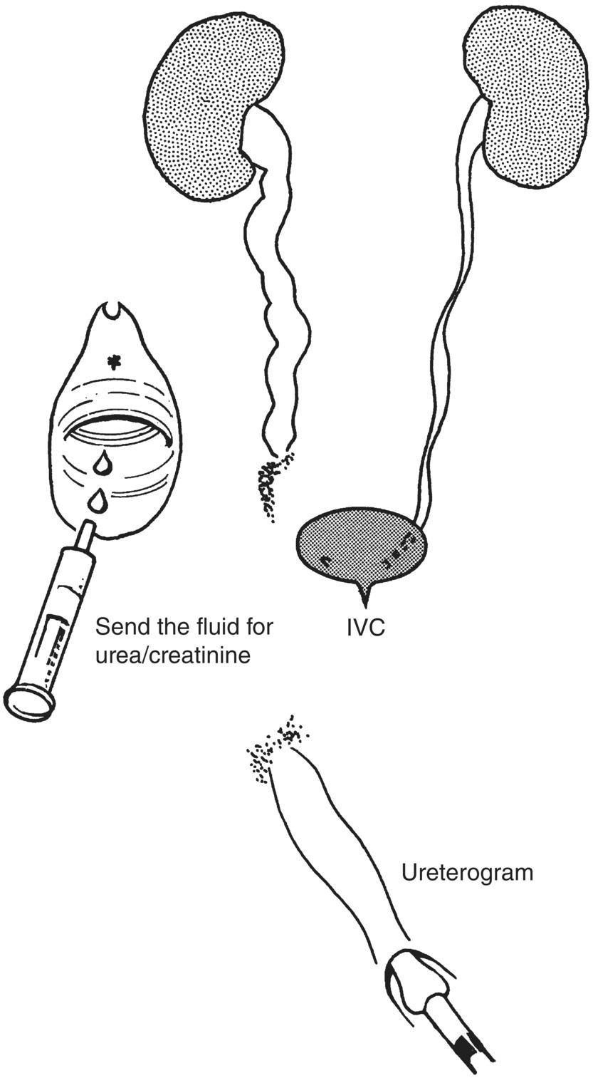 Bladder Trauma | Abdominal Key