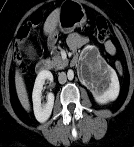 Tubular, Interstitial, and Cystic Disorders | Abdominal Key