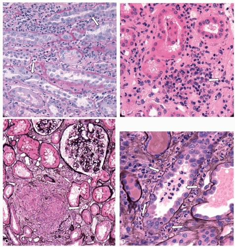 Tubular, Interstitial, and Cystic Disorders | Abdominal Key