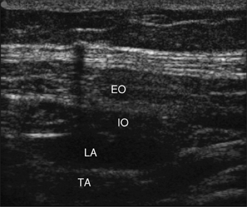 Intercostal, Intrapleural, and Peripheral Blockade of the Thorax and ...