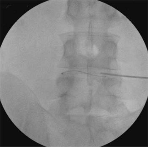 Spinal Pain and the Role of Neural Blockade | Anesthesia Key