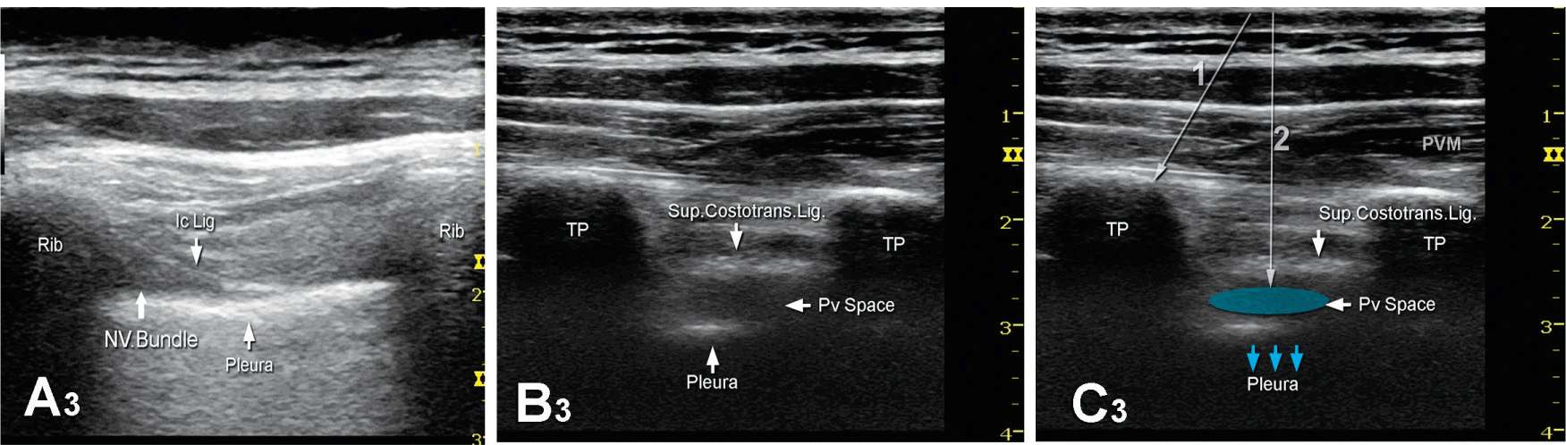 Sonography of Thoracic Paravertebral Space and Considerations for ...