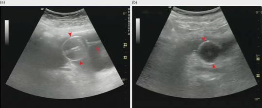 Bladder ultrasound for catheterization and suprapubic aspiration ...