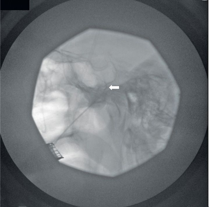Trigeminal Ganglion and Nerve Block | Anesthesia Key