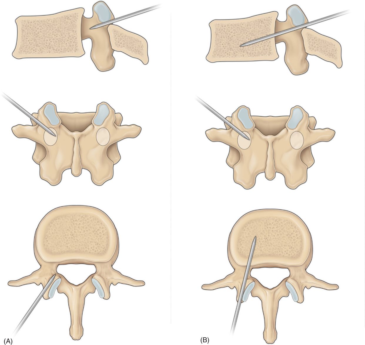 Vertebral Augmentation | Anesthesia Key