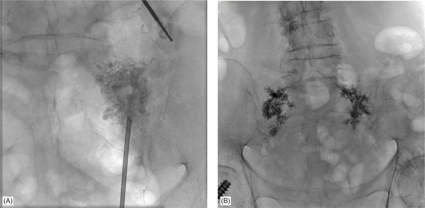Percutaneous Sacroplasty | Anesthesia Key