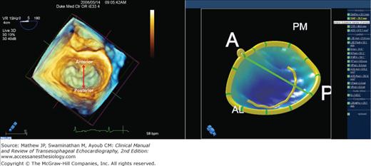 Mitral Valve | Anesthesia Key