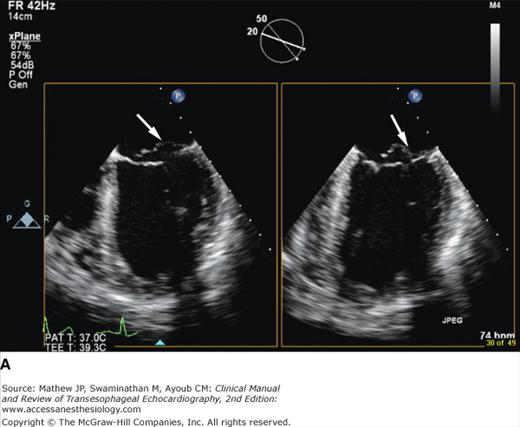 Mitral Valve | Anesthesia Key