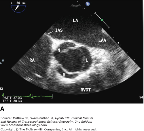 Aortic Valve | Anesthesia Key