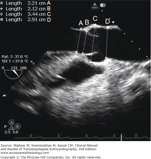 Aortic Valve | Anesthesia Key