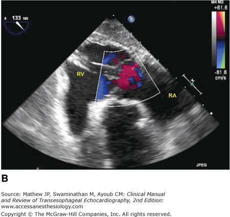 Evaluation of Right Heart Function | Anesthesia Key