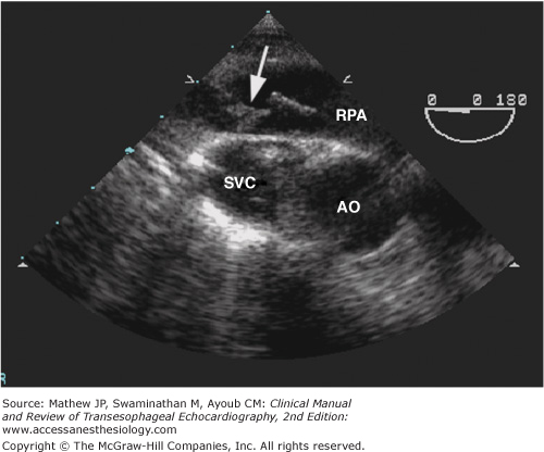 TEE for Noncardiac Surgery | Anesthesia Key