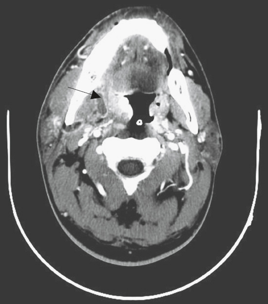Infections of the Head and Neck | Anesthesia Key