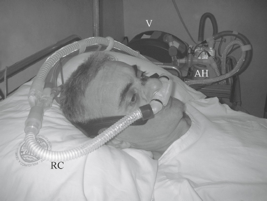 Noninvasive Ventilatory Support Modes | Anesthesia Key