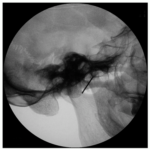 Ultrasound-Guided Sphenopalatine Ganglion Block | Anesthesia Key