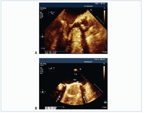 Common Artifacts and Pitfalls of Clinical Echocardiography | Anesthesia Key