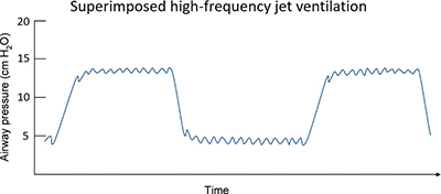 High-Frequency Ventilation: Applications in Thoracic Anesthesia ...