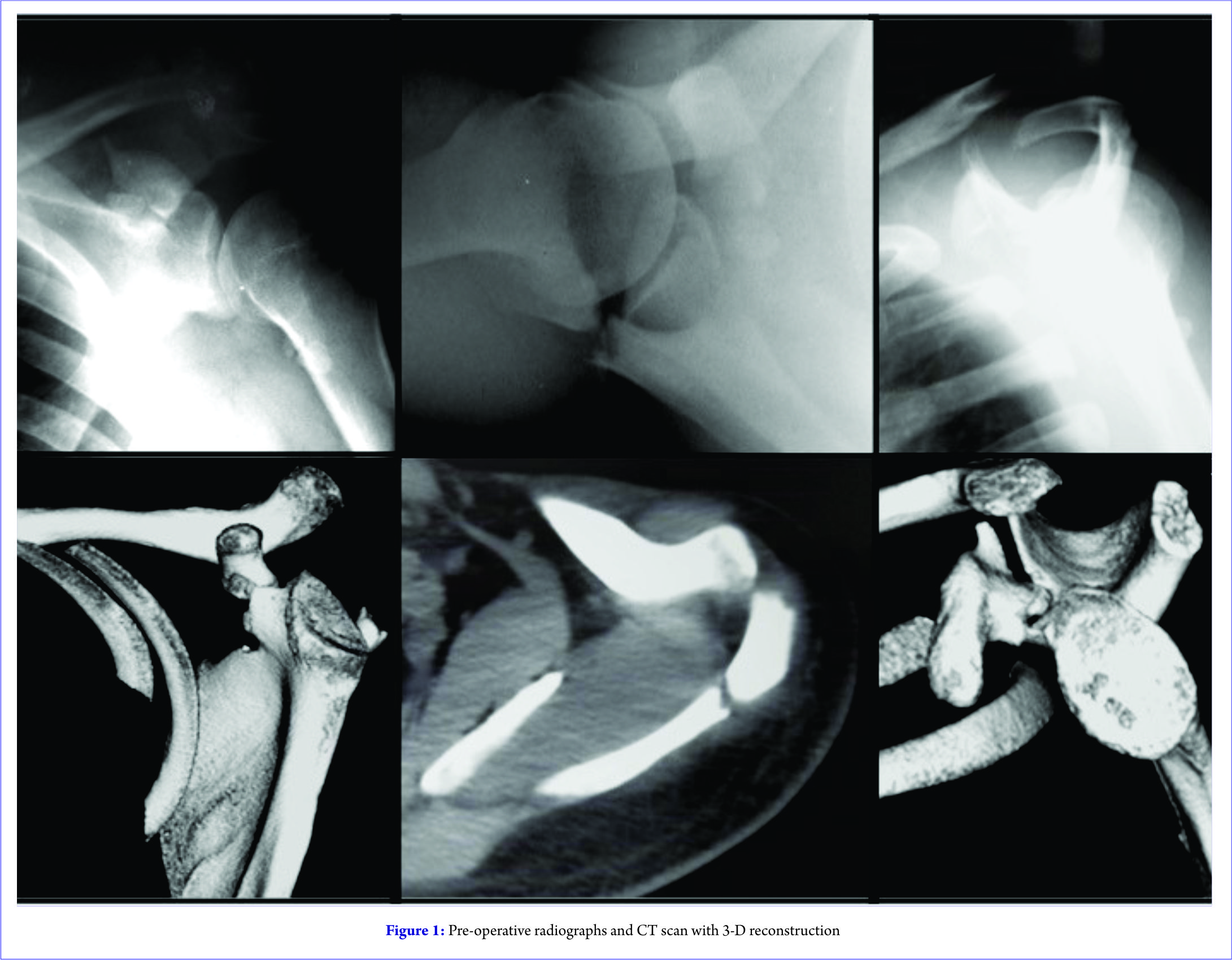 A Comprehensive Review of Triple Disruptions of the Superior Shoulder ...