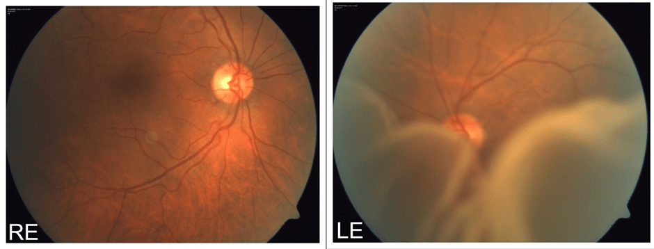 Spontaneous Giant Retinal Pigment Epithelium Rip with Exudative Retinal ...