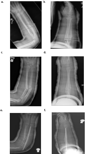 The Role of Obesity on Cast Index and Secondary Intervention in ...