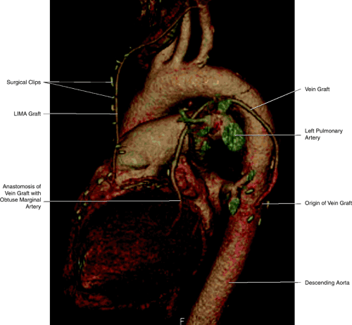 Heart and Coronary Arteries | Basicmedical Key