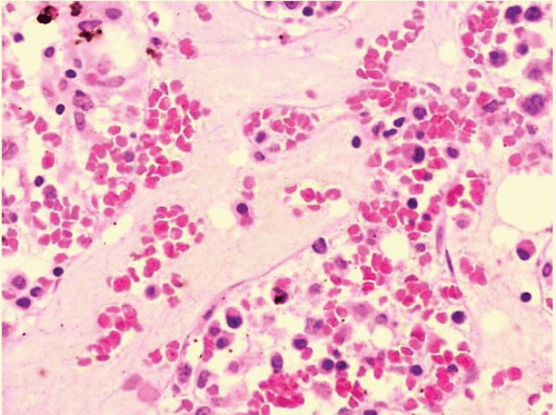 Bone Marrow Procedure, Examination, and Reporting | Basicmedical Key