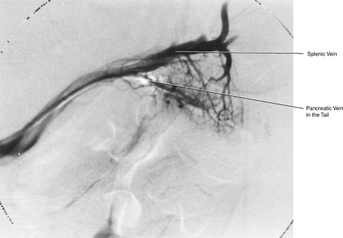 Veins of the Abdomen and Pelvis | Basicmedical Key
