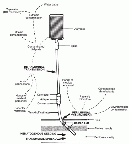 Infections Associated With Peritoneal Dialysis | Basicmedical Key