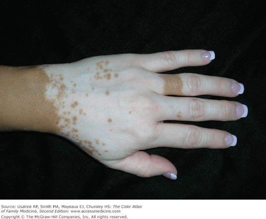 Nummular Eczema | Basicmedical Key