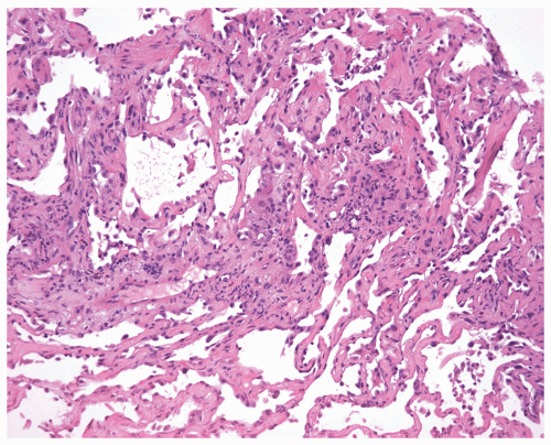 Methotrexate | Basicmedical Key