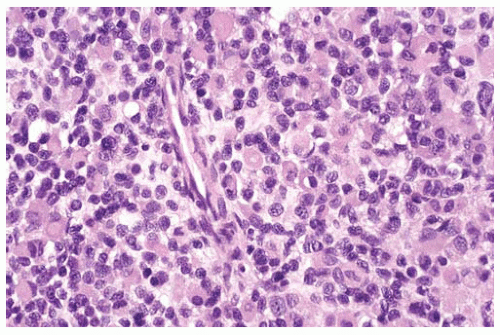 Pleuropulmonary Blastoma | Basicmedical Key