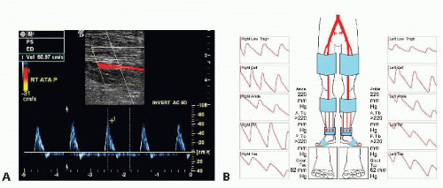 Tibial Interventions: Tibial-Specific Angioplasty Considerations and ...
