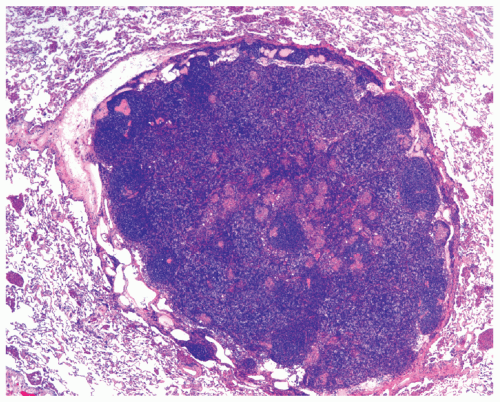 Intrapulmonary Lymph Nodes | Basicmedical Key