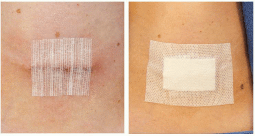 Open Neck Exploration for Primary Hyperparathyroidism | Basicmedical Key