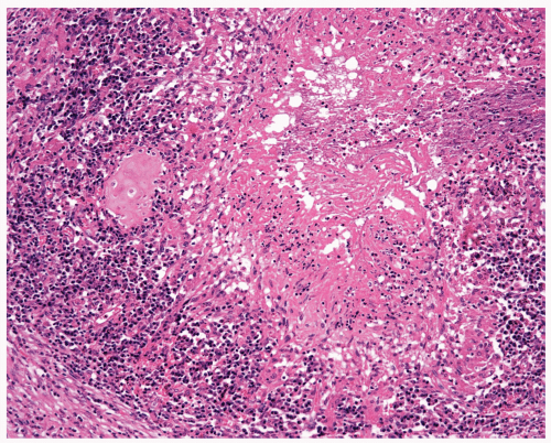Bronchocentric Granulomatosis | Basicmedical Key
