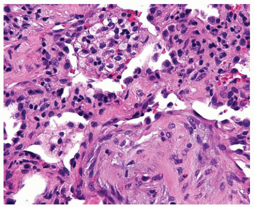 Organizing Pneumonia (Bronchiolitis Obliterans Organizing Pneumonia ...