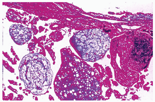 Emphysema | Basicmedical Key